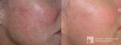 Pre-Cancerous Sun Spots | Before and After Photos | Sydney Specialist ...