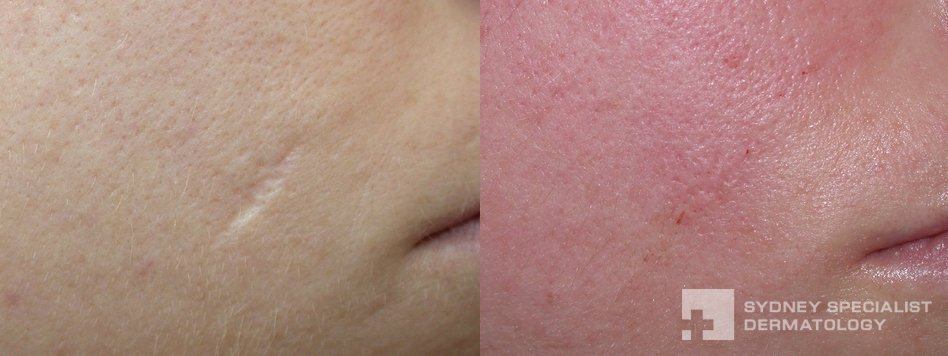Treatment of Scars | Before and After Photos | Sydney Specialist ...