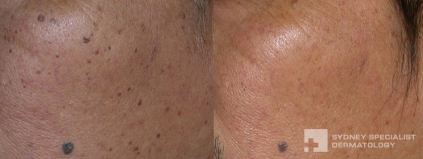 Gallery | Removal of Skin Lesions | Sydney Specialist Dermatology